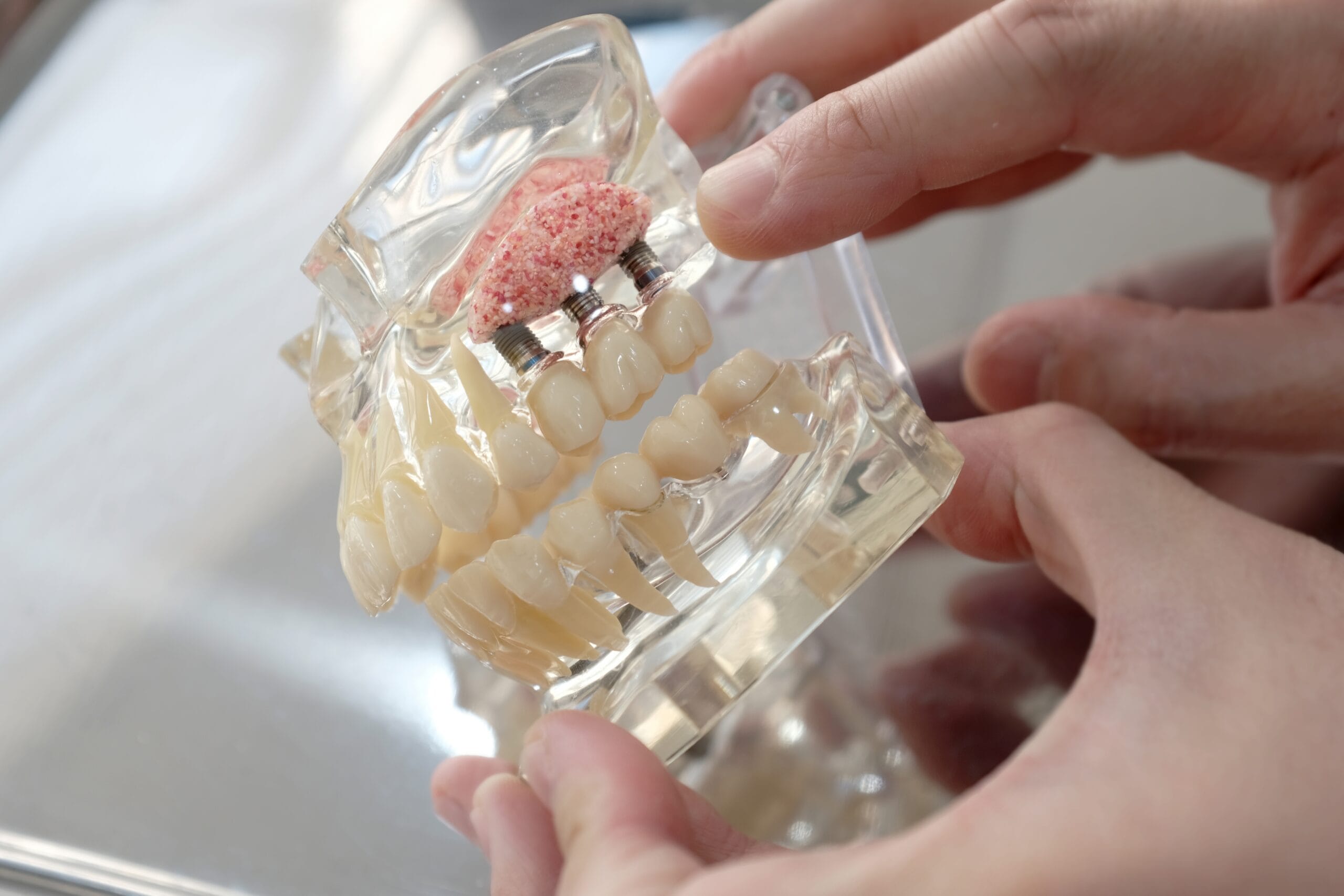 What is a Dental Bone Graft? | Red Hills Dental